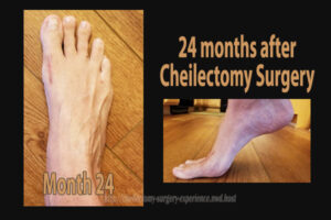 2 Years After Big Toe (Cheilectomy) Surgery - Recovery Expectation