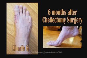 Six Months After Big Toe Surgery - Recovery Expectation